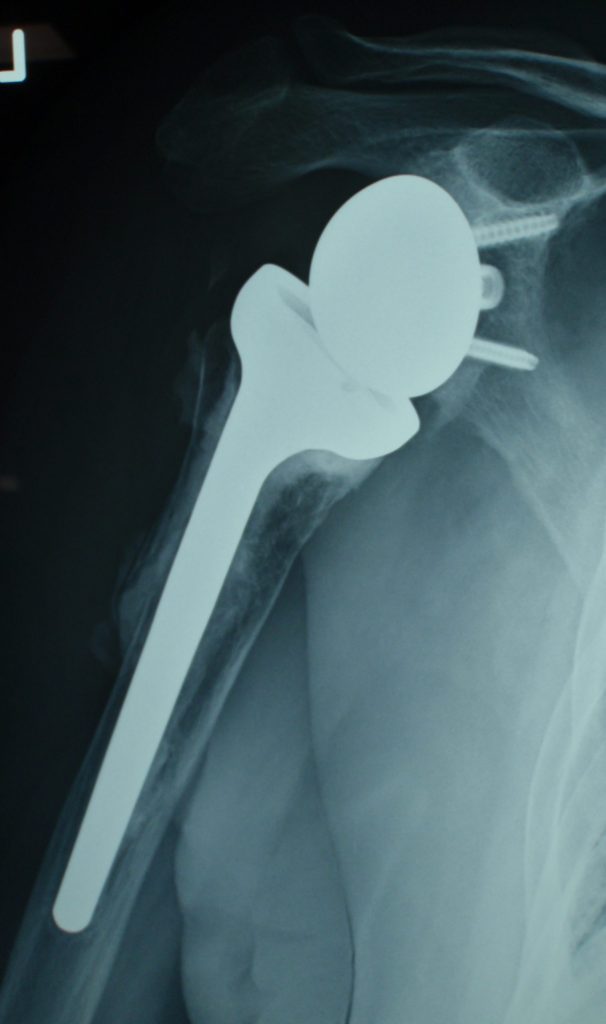 Shoulder Joint Replacement - Gold Coast Hand + Upper Limb Clinic