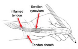 De Quervain’s Tenosynovitis - Gold Coast Hand + Upper Limb Clinic